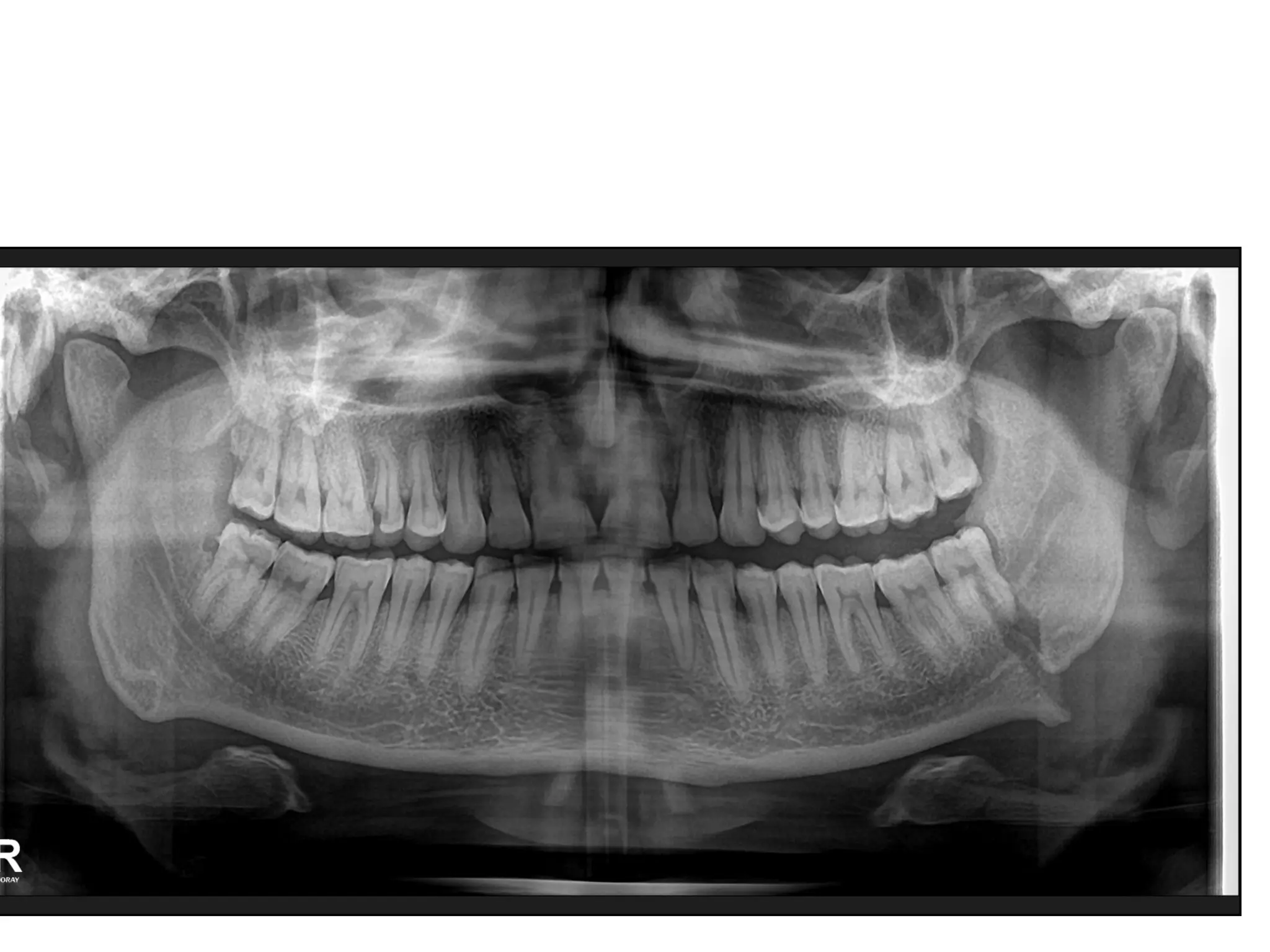 Fracture of opg interpretation of left side | PPTX