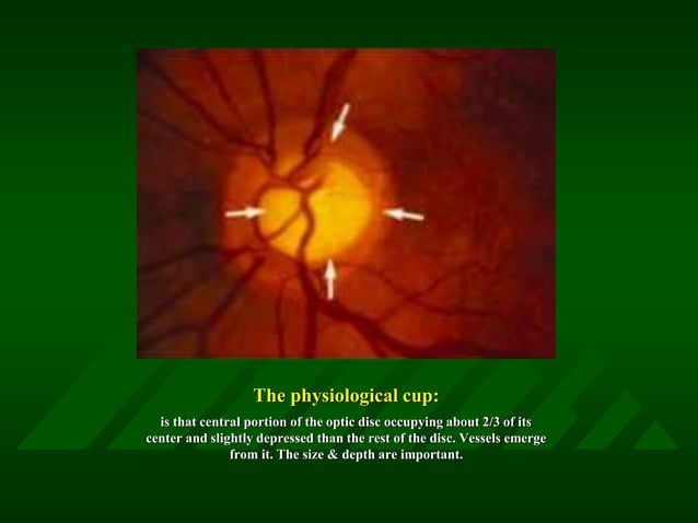 Principles of Ophthalmoscopy | PPTX | Eye and Vision Conditions ...