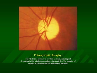 Principles of Ophthalmoscopy | PPTX