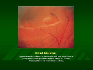 Principles of Ophthalmoscopy | PPTX