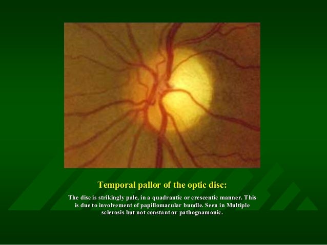 Principles of Ophthalmoscopy