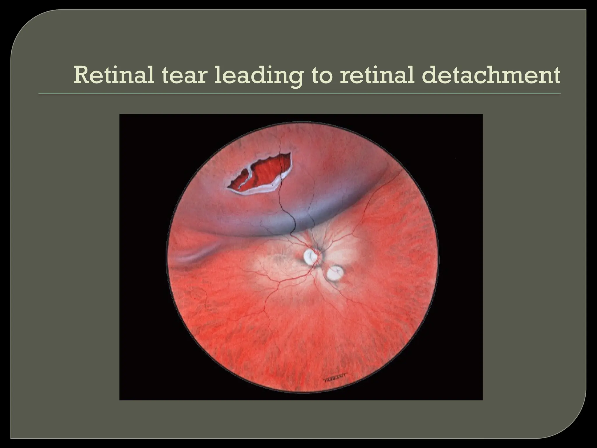 Common retinal disorders for medical.pptx