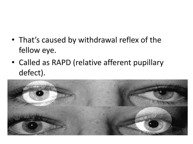 Abnormal Pupil Reactions | PPTX