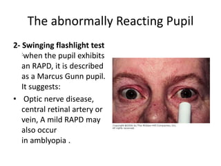 Abnormal Pupil Reactions | PPTX