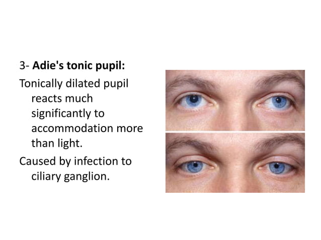 Abnormal Pupil Reactions | PPT