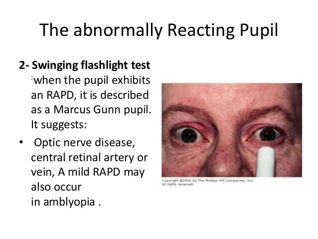 Abnormal Pupil Reactions