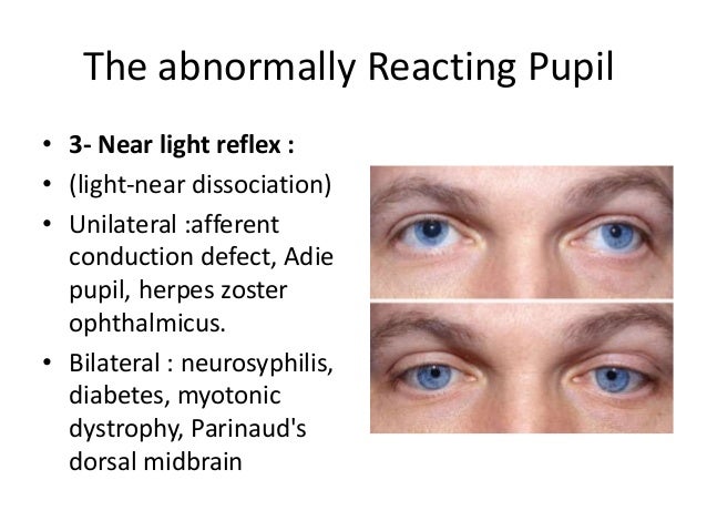 Abnormal Pupil Reactions
