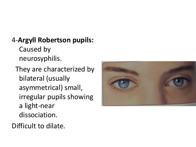 Abnormal Pupil Reactions