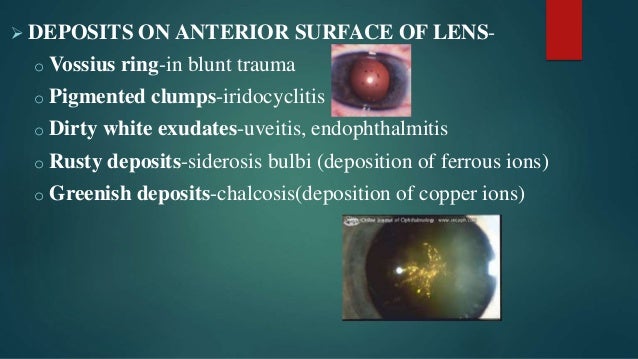 Ophthal examination of eye