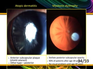 Shield Cataract Atopic Dermatitis