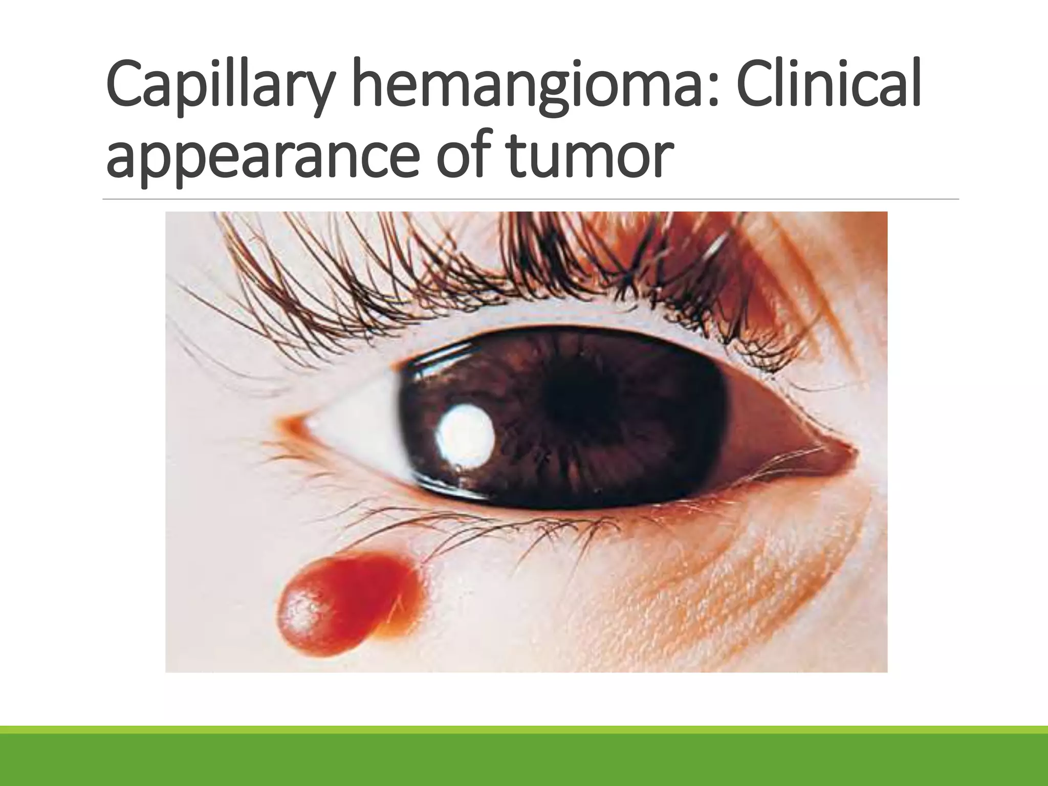Pathology of common ocular and orbital tumors | PPTX