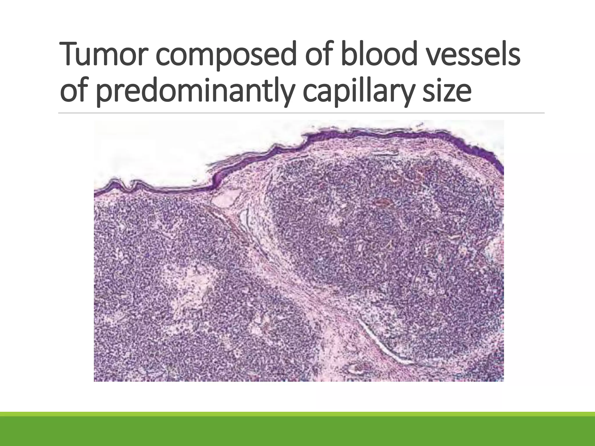 Pathology of common ocular and orbital tumors | PPTX