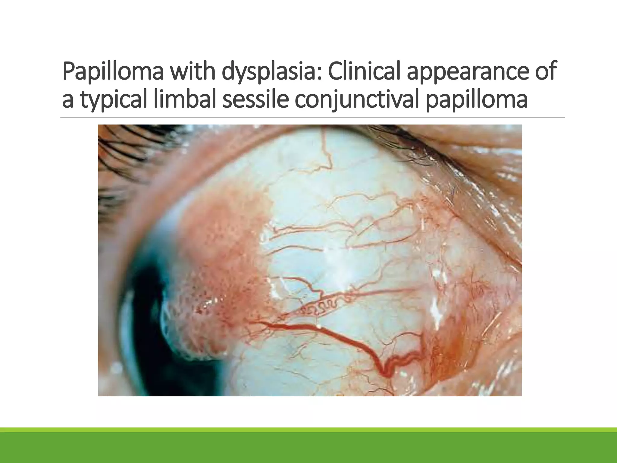Pathology of common ocular and orbital tumors | PPTX