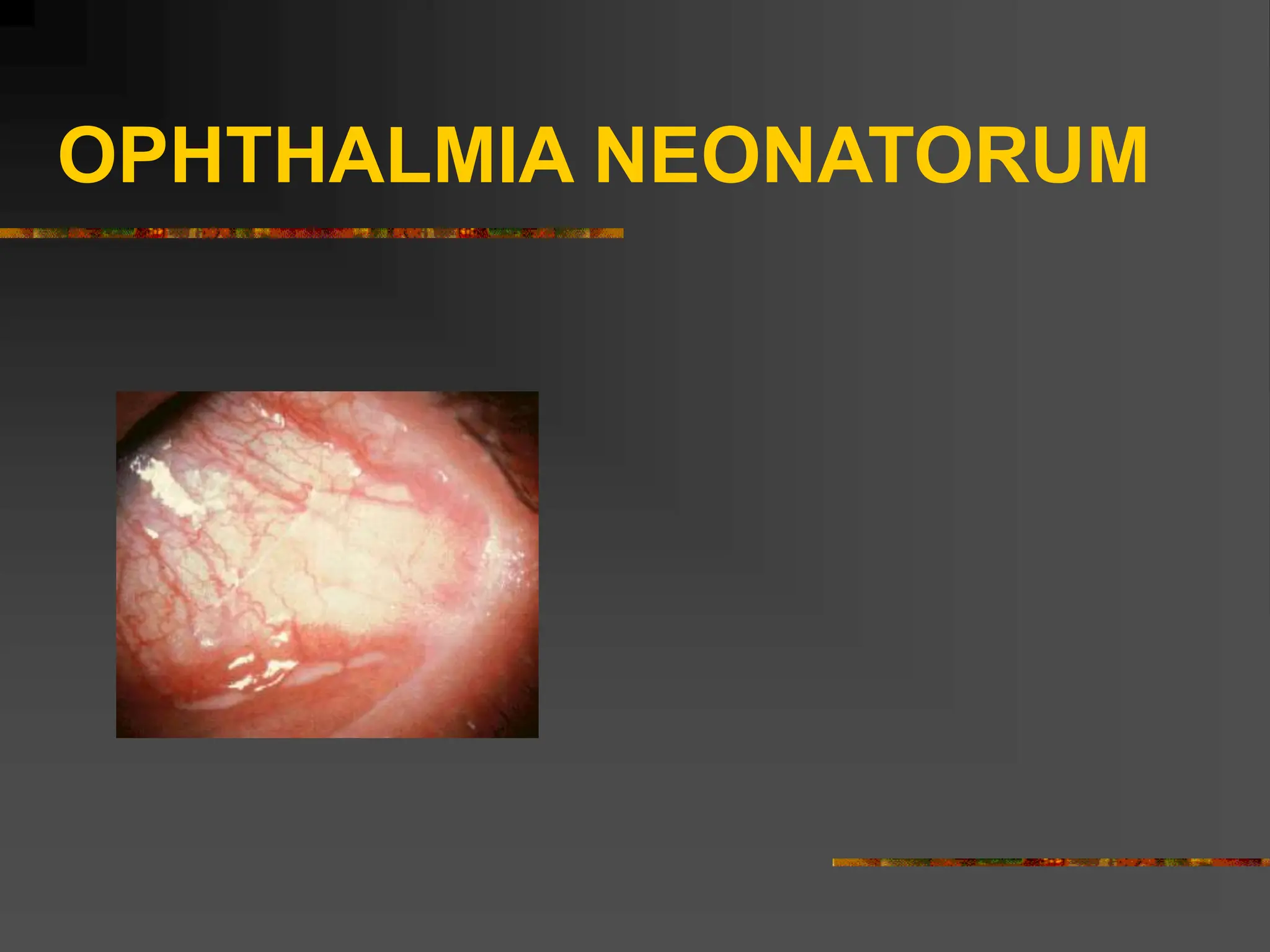 ophthalmianeonatorum-1.ppt ophthalmianeonatorum | PPT
