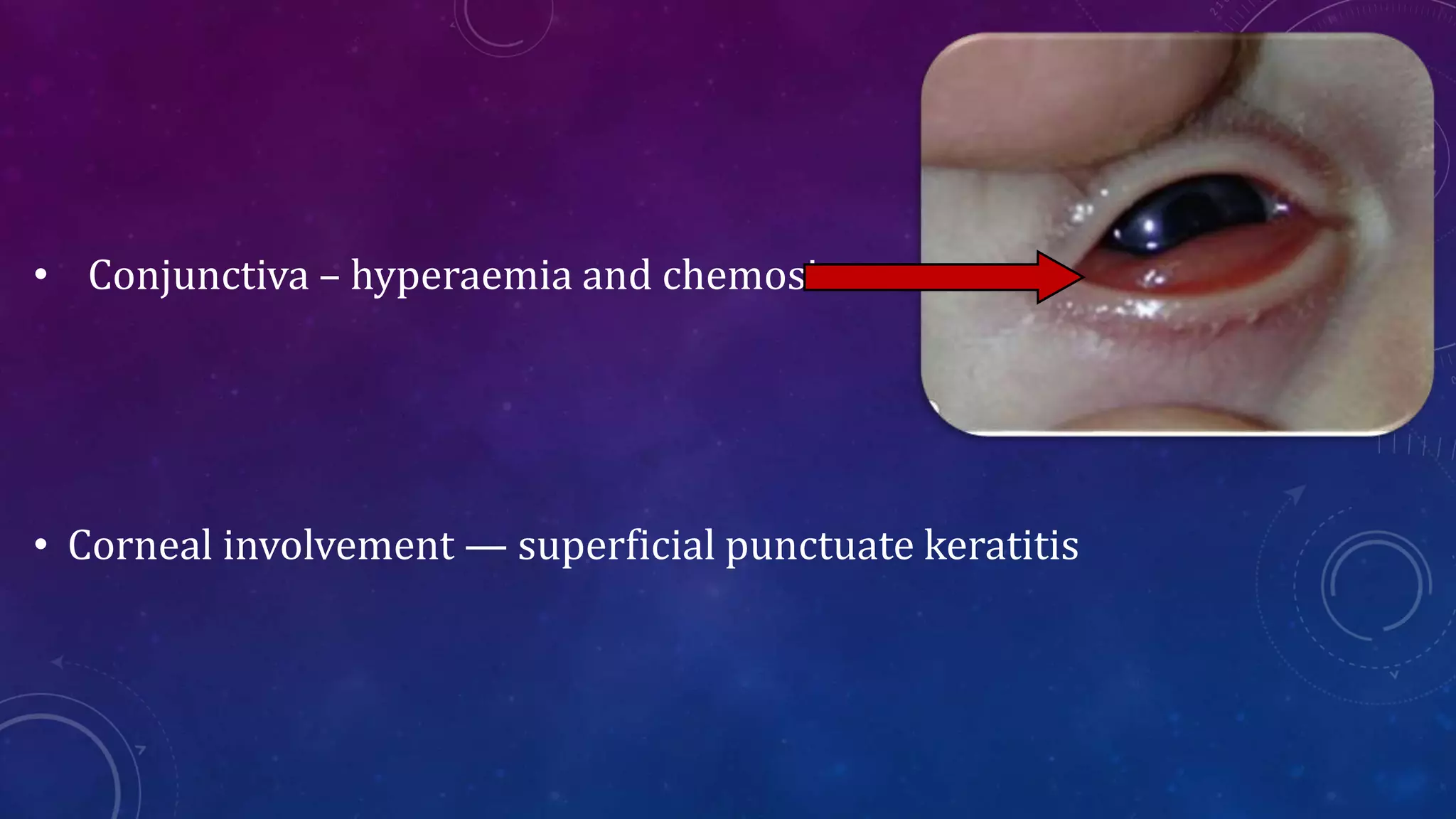 Ophthalmia Neonatorum/ Neonatal Conjunctivitis | PPTX