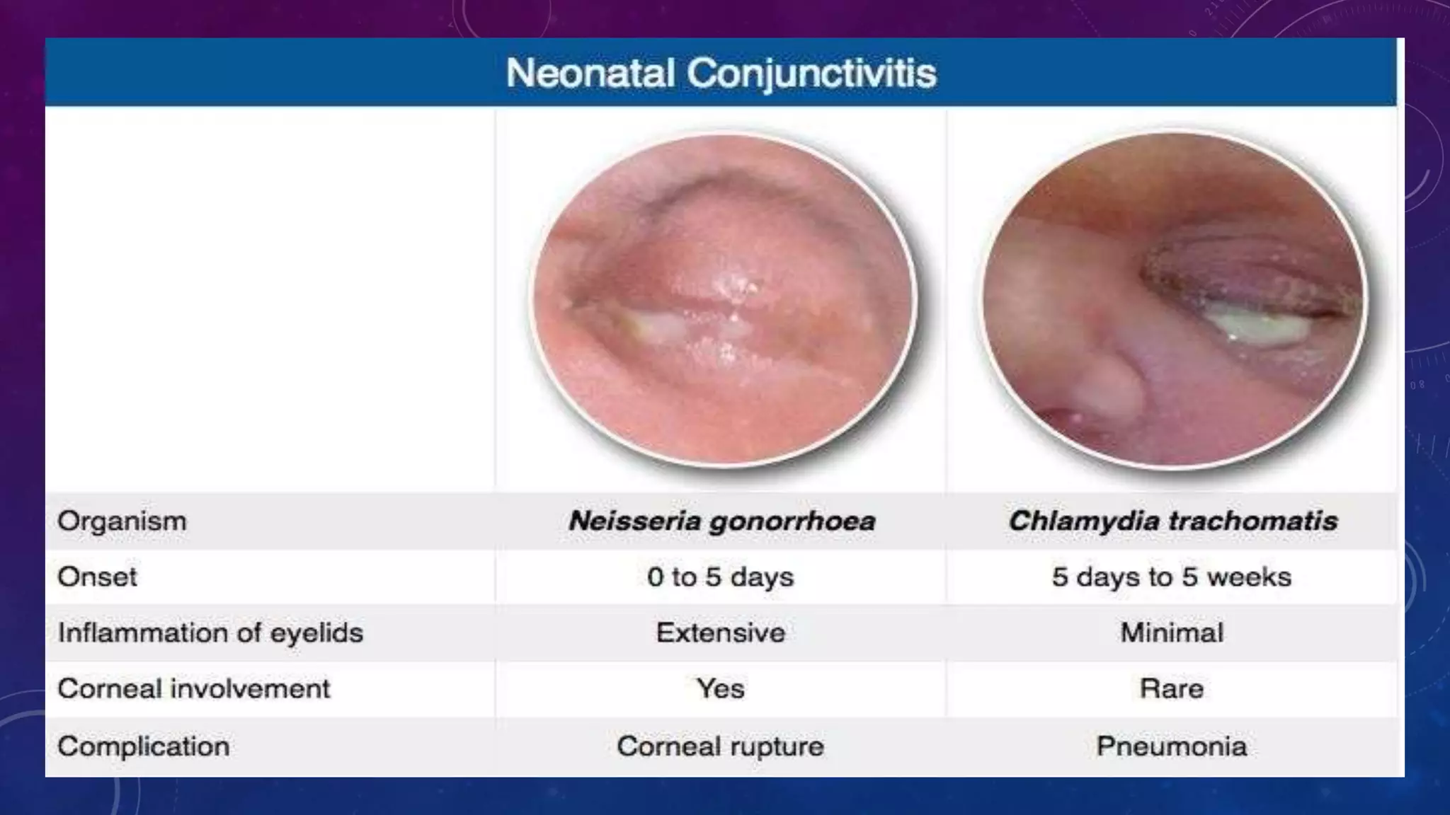 Ophthalmia Neonatorum/ Neonatal Conjunctivitis | PPTX
