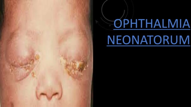 Ophthalmia Neonatorum/ Neonatal Conjunctivitis | PPTX | Eye and Vision ...