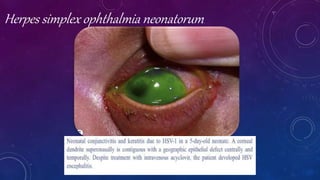 Ophthalmia Neonatorum/ Neonatal Conjunctivitis | PPTX