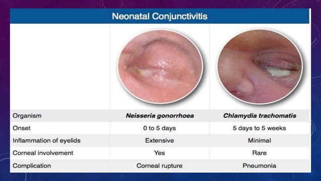 Ophthalmia Neonatorum/ Neonatal Conjunctivitis