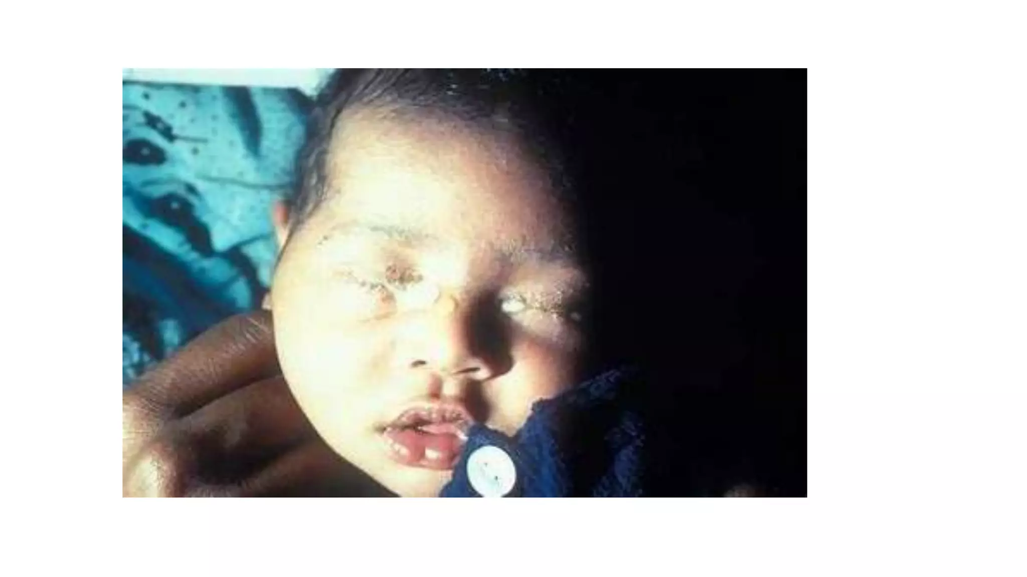 Ophthalmia neonatorum bondi | PPTX