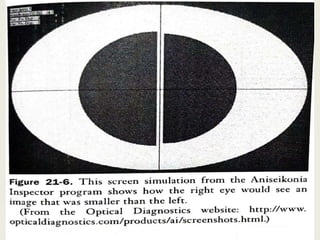 Ophthalmic dispensing in Anisometropia and Aniseikonia.pptx