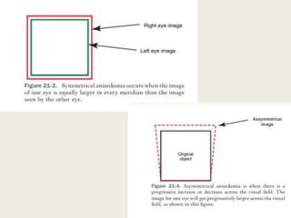 Ophthalmic dispensing in Anisometropia and Aniseikonia.pptx