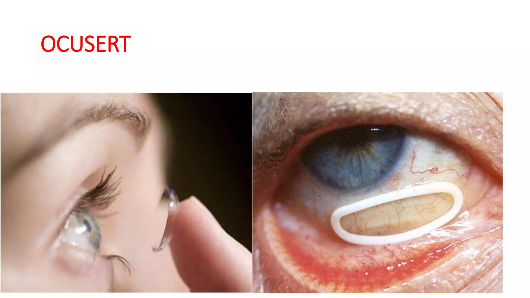 Ophthalmic drug delivery systems | PPTX