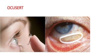 Ophthalmic drug delivery systems | PPT