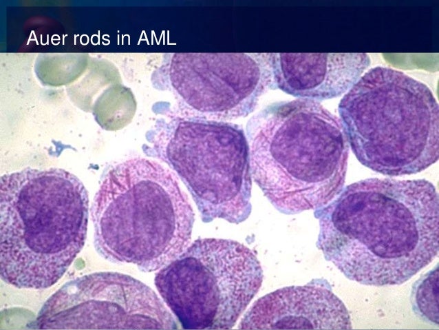 Auer Rods Codehealth Note Multiple Auer Rods Which Are Found Only In Acute Myeloid Leukemias