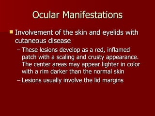 Lupus and Your Eyes | PPT