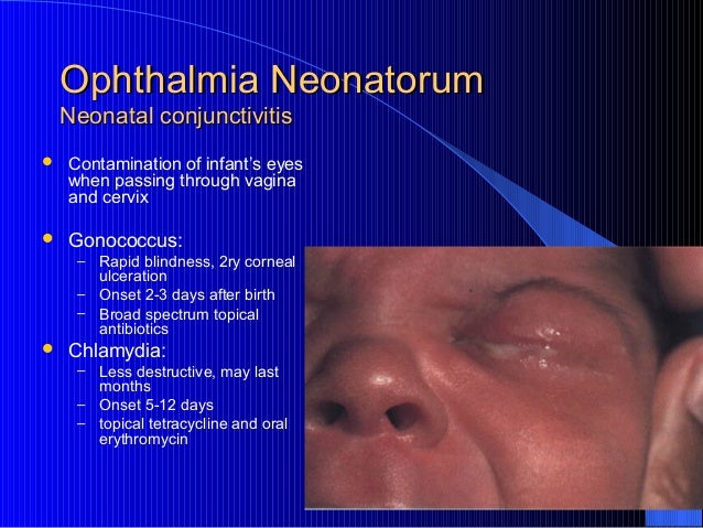 Neonatal Gonococcal Conjunctivitis Ophthalmia Neonatorum