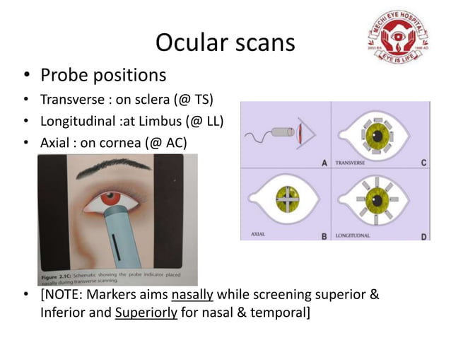 A quick guide to Ophthalmic Ultrasound/ B-Scan interpretation | PPTX