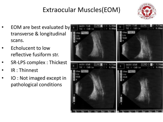A quick guide to Ophthalmic Ultrasound/ B-Scan interpretation | PPTX