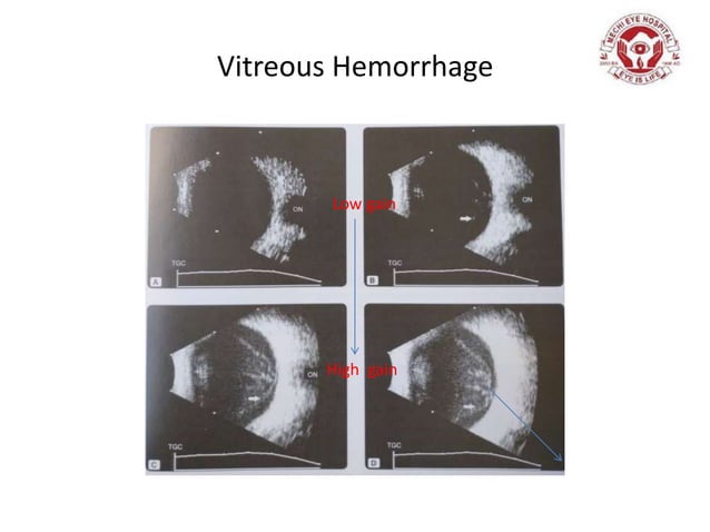 A quick guide to Ophthalmic Ultrasound/ B-Scan interpretation | PPTX