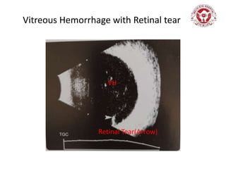 A quick guide to Ophthalmic Ultrasound/ B-Scan interpretation | PPTX