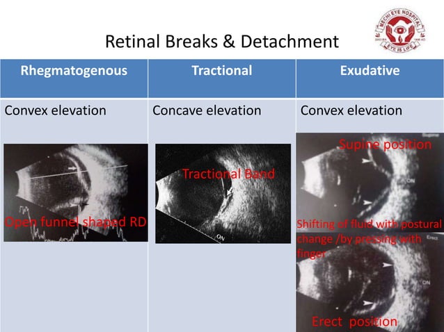 A quick guide to Ophthalmic Ultrasound/ B-Scan interpretation | PPTX