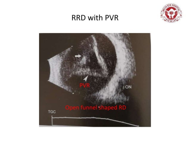 A quick guide to Ophthalmic Ultrasound/ B-Scan interpretation | PPTX