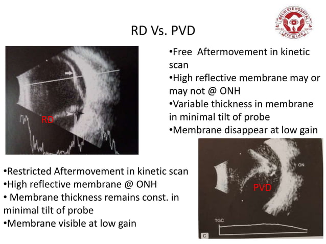A quick guide to Ophthalmic Ultrasound/ B-Scan interpretation | PPTX