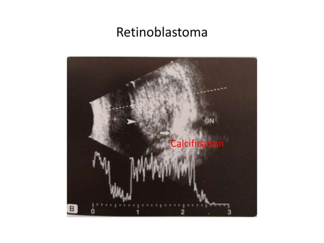 A quick guide to Ophthalmic Ultrasound/ B-Scan interpretation | PPTX