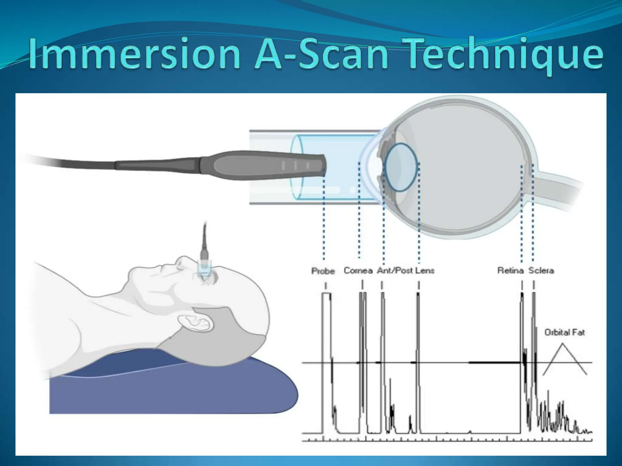 Study about Ophthalmic Ultrasonography.ppt