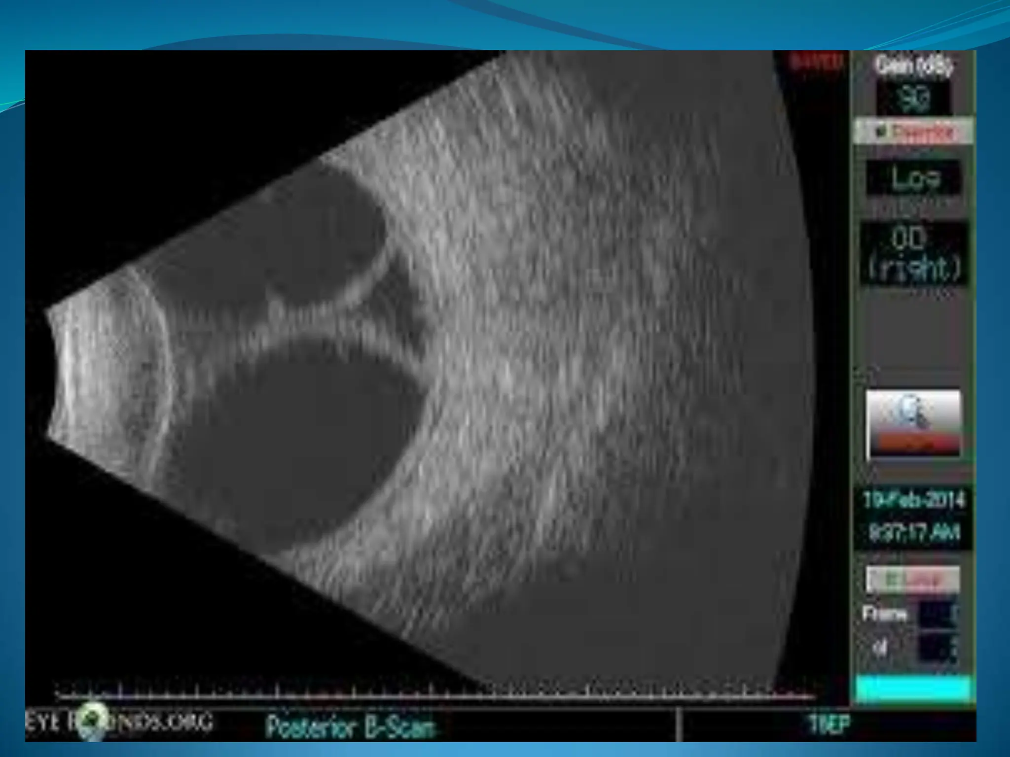 Study about Ophthalmic Ultrasonography.ppt