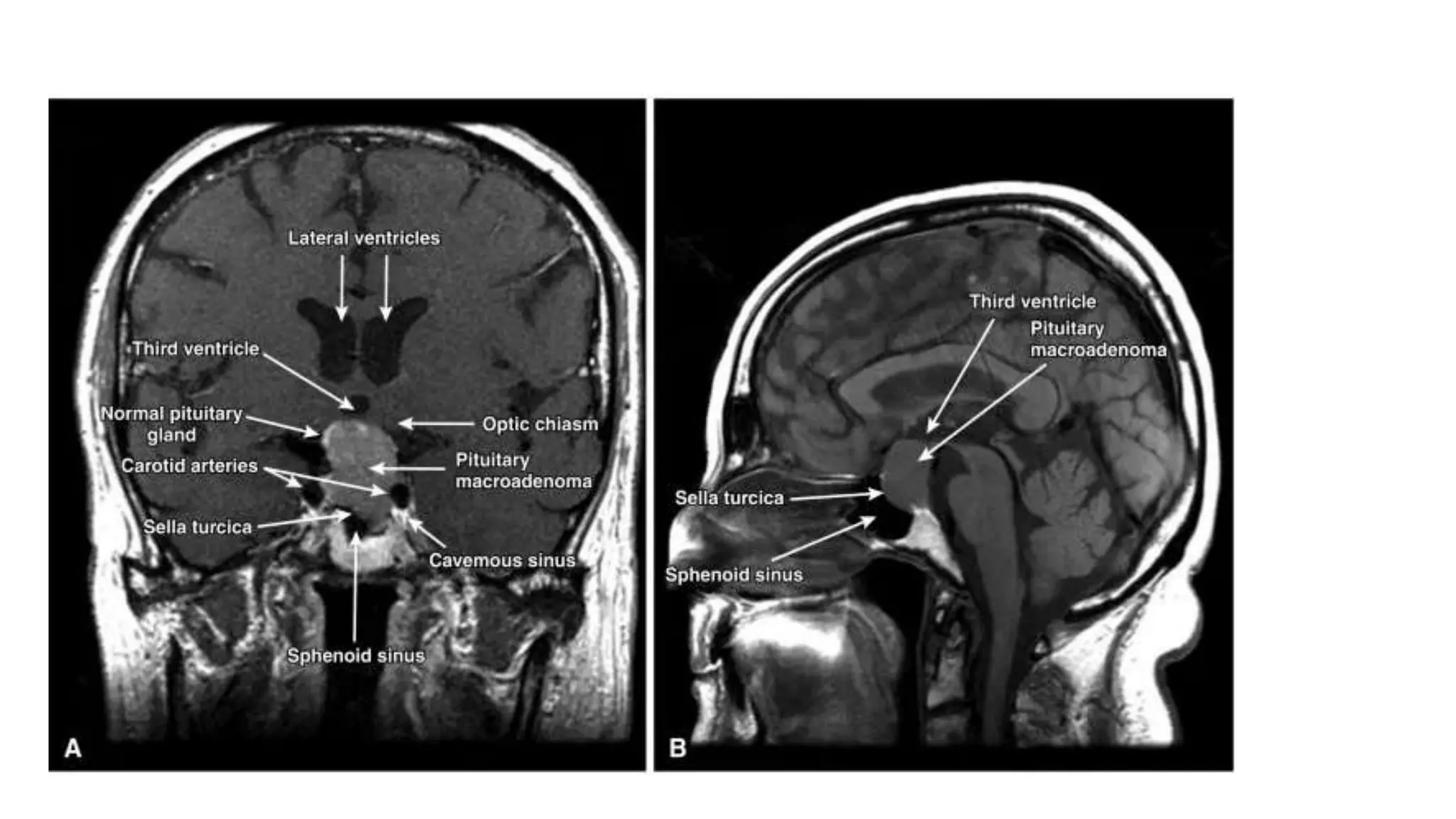 Ophthalmological evalution in sellar suprasellar tumours | PPTX