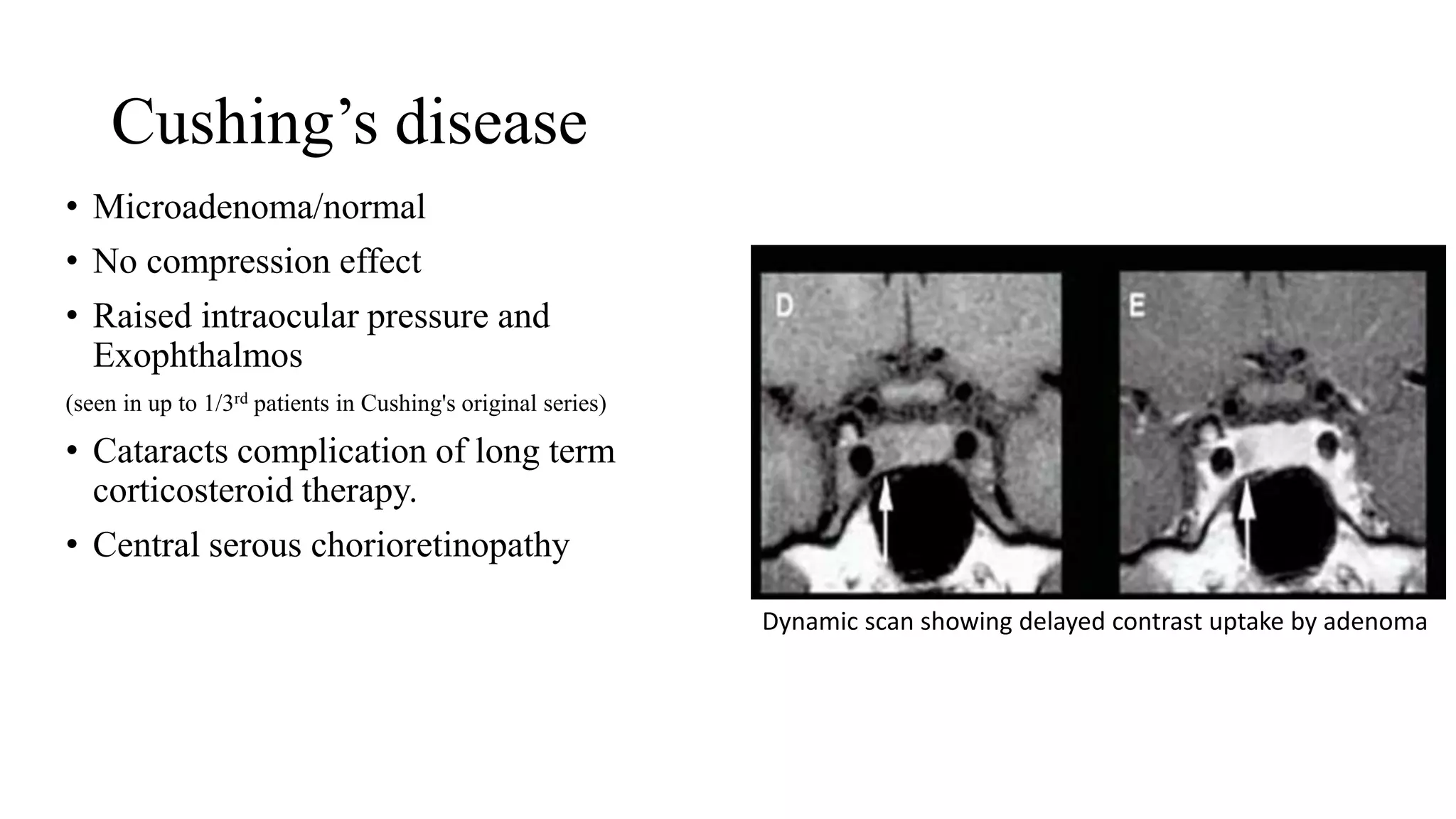 Ophthalmological evalution in sellar suprasellar tumours | PPTX