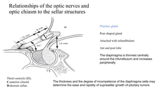 Ophthalmological evalution in sellar suprasellar tumours | PPTX