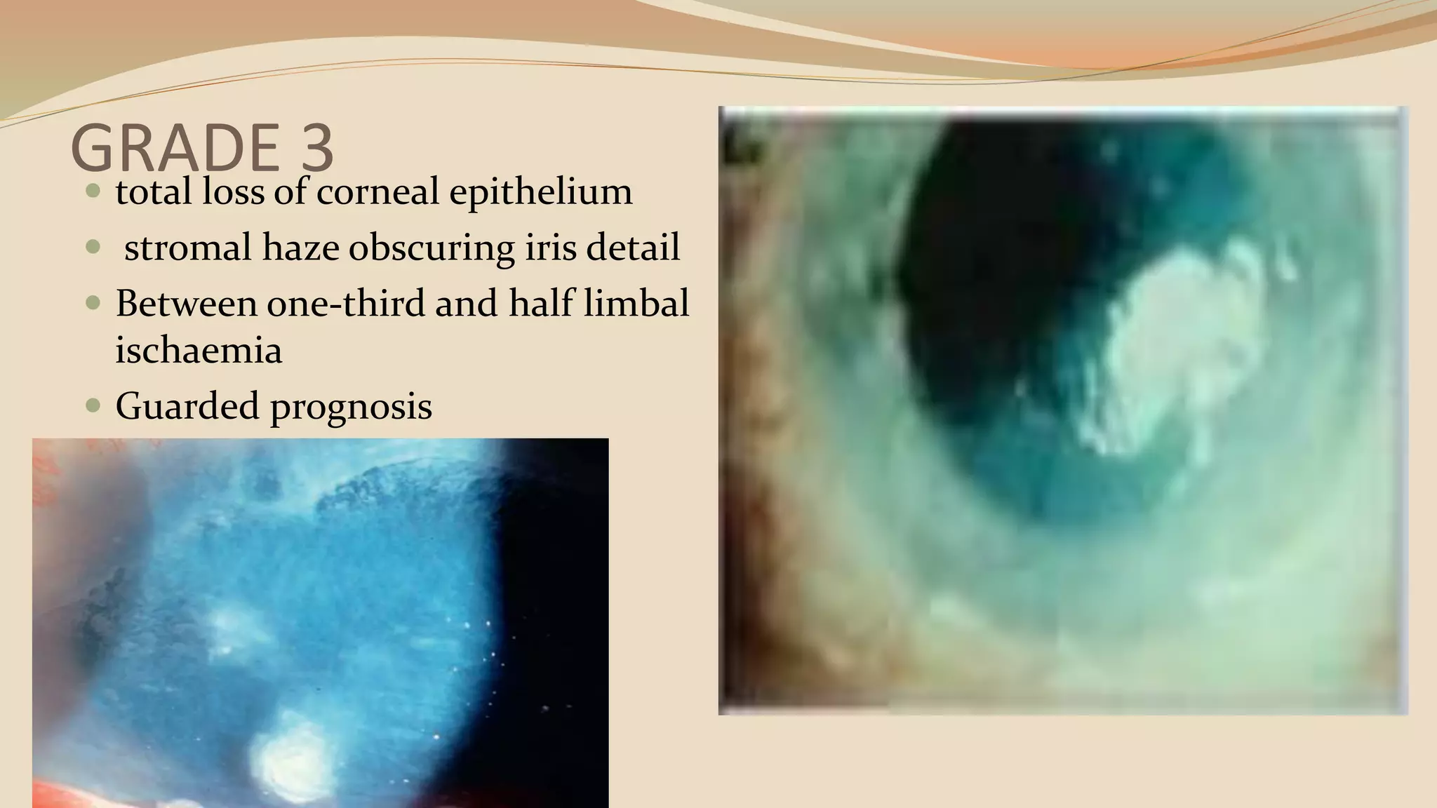 Ophthalmologic approach to chemical burns | PPTX