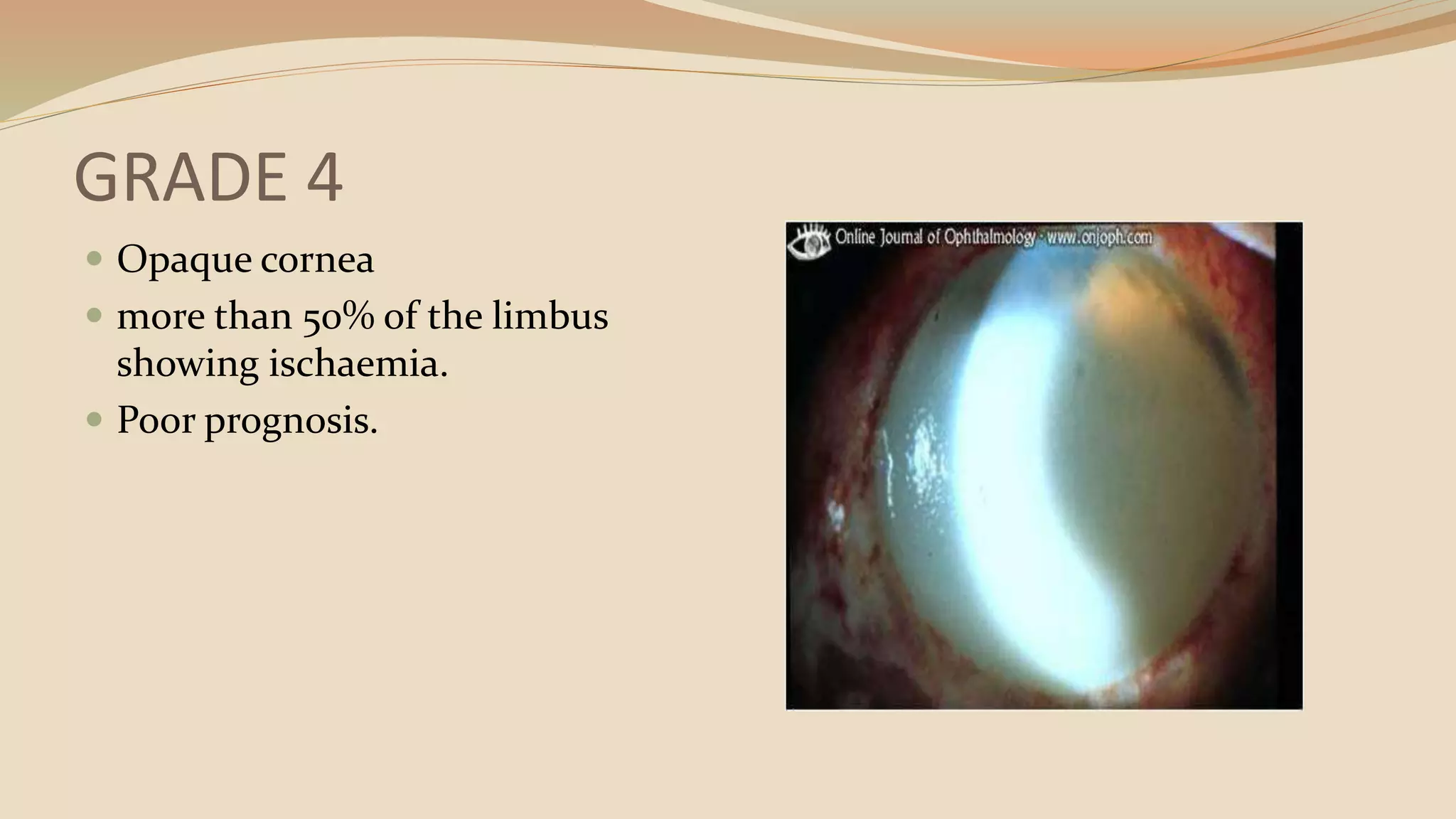 Ophthalmologic approach to chemical burns | PPTX