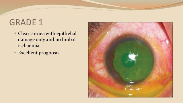 Ophthalmologic approach to chemical burns
