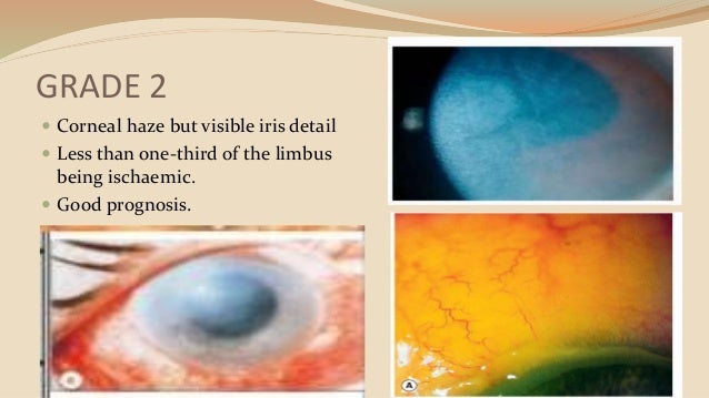 Ophthalmologic approach to chemical burns