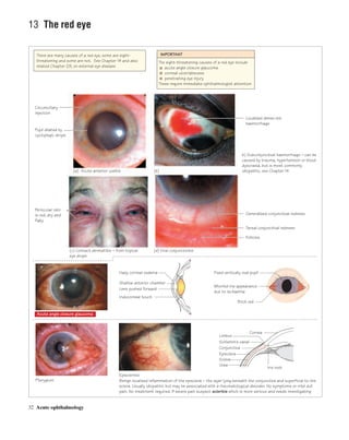 Ophthalmology at a Glance............pdf