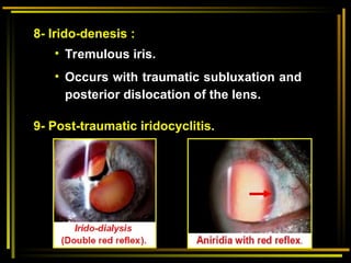 Ophthalmologyblunt ocular truma lecture.ppt